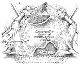 Site Specific Posterior Repair